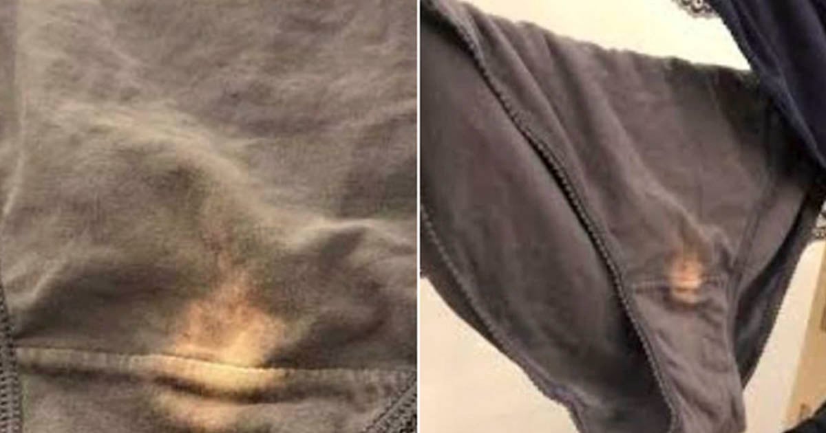 People Are Just Finding Out Why They Get Bleach Patches On Their ...